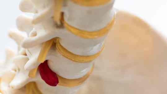 How Long Does a Herniated Disc Take to Heal | Bulging Disc Recovery Time