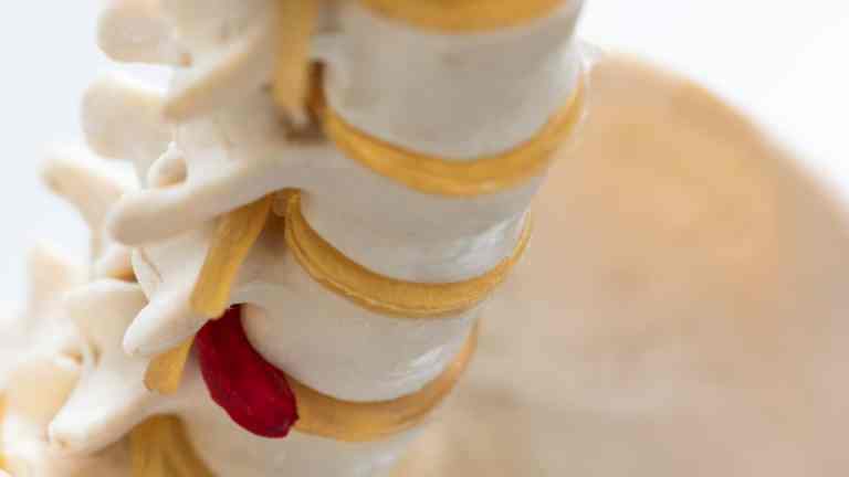 How Long Does a Herniated Disc Take to Heal | Bulging Disc Recovery Time