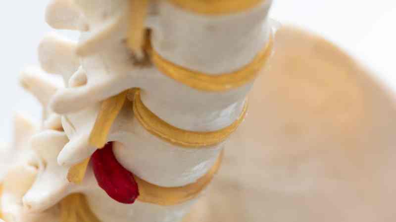 Herniated Disc Recovery Time _ Herniated Disc Healing Timeline – GQVUL