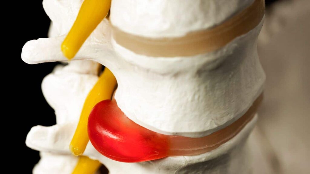 Herniated Disc Healing: Timeline and Signs of Improvement